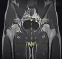 MRI Pelvis Sports Hernia WO MSK Protocol | OHSU